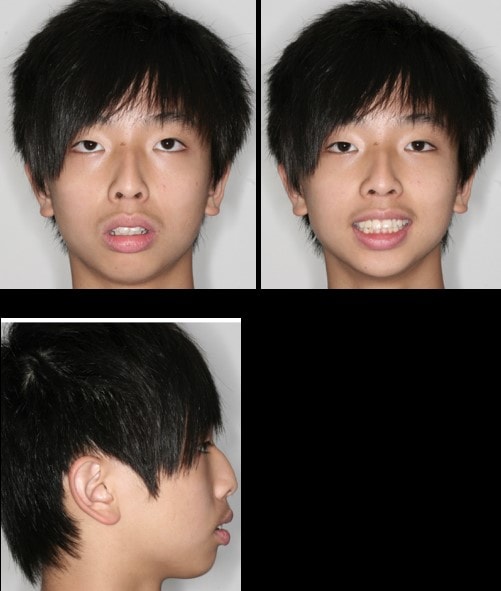 Improving facial profile and correction of a Class II Division 1 ...